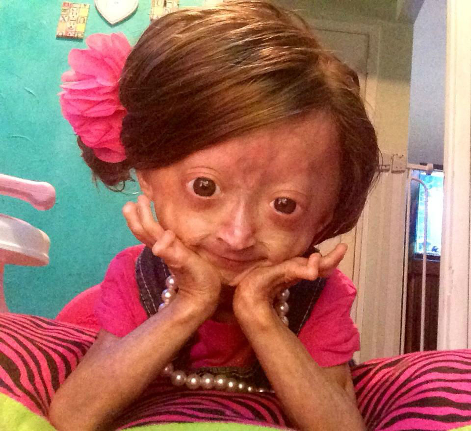 Adalia Rose ผู้หญิงที่มีคนติตามในเฟสบุ๊คเกือบ 10 ล้านคน!!!! | Dek-D.com