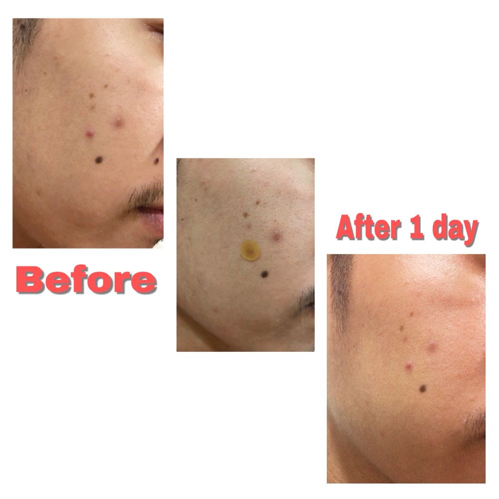 [Review] แผ่นซับสิว Acne Q | Dek-D.com